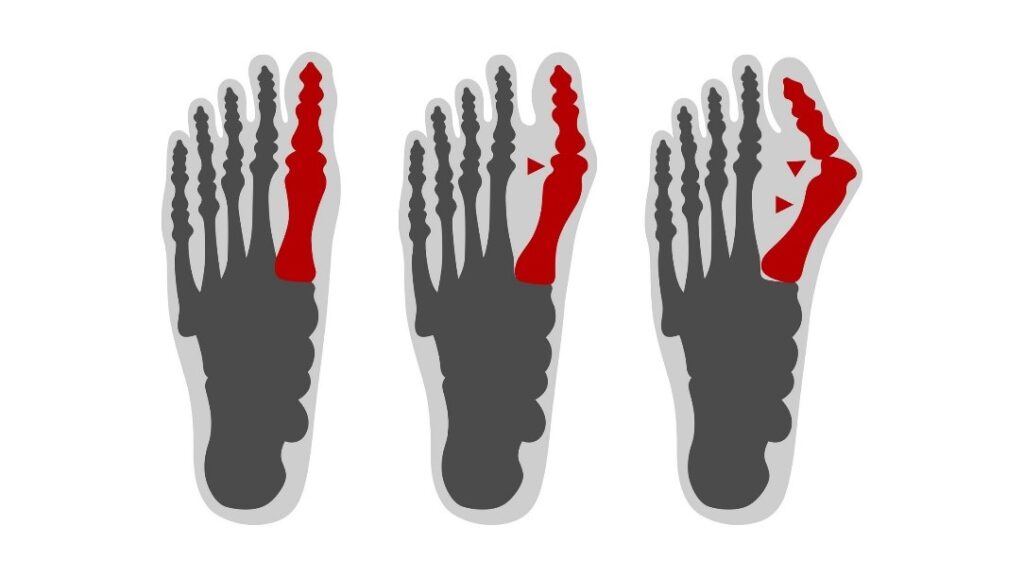 HALLUX VALGUS: deformacija nožnega palca – Mitral